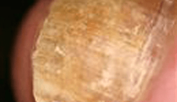 Yellow Nail Syndrome: Causes, Symptoms, and Solutions